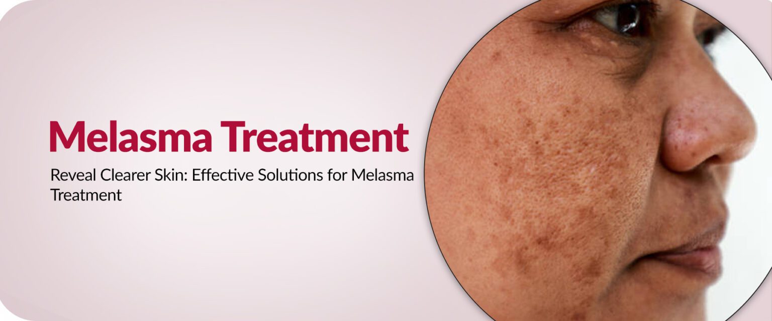 Melasma Treatment for Brighter Skin – Dr. Vijay Kumar