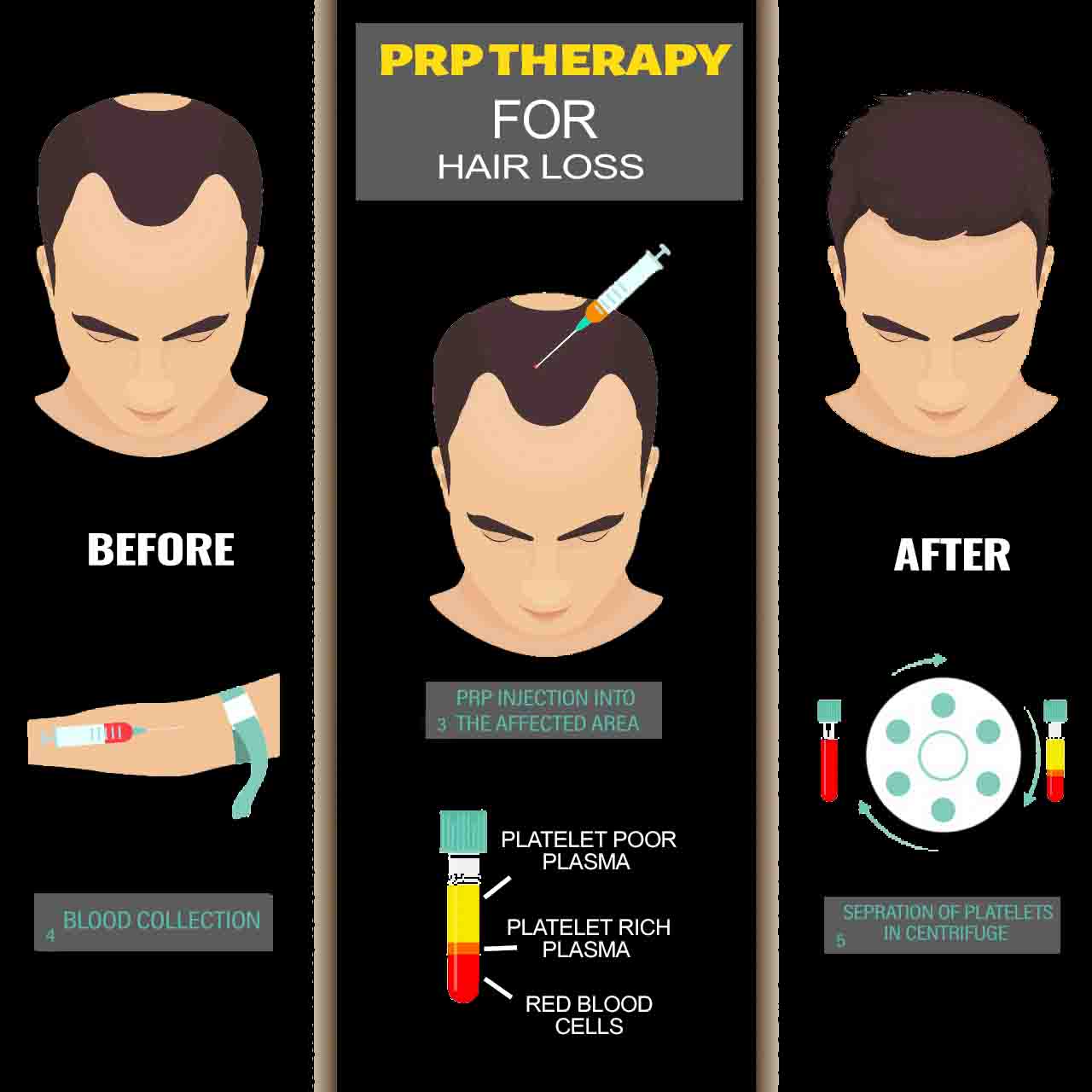 PRP Treatment - AWISH Clinic PRP Treatment - AWISH Clinic