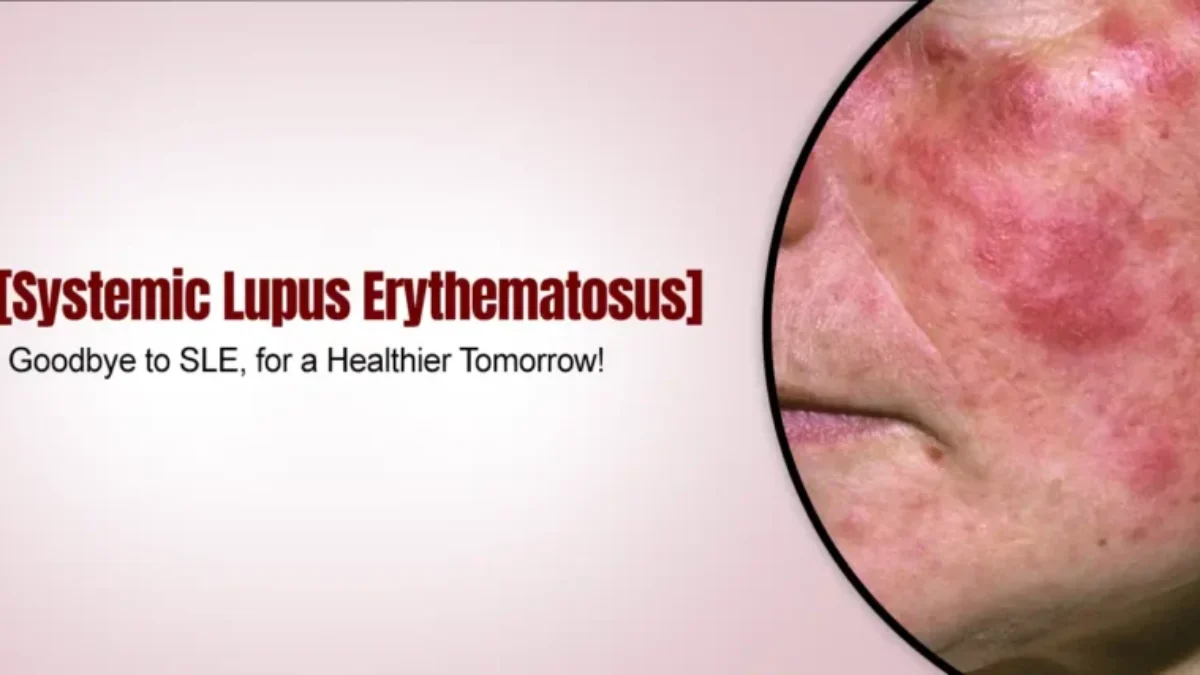 Erythematosus Sle Systemic Lupus Erythematosus (SLE) Medizin 3
