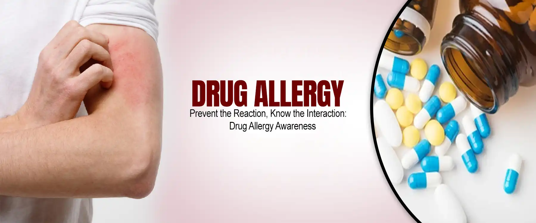 Drug Allergy: Reaction, Causes, Symptoms, Diagnosis & Treatment